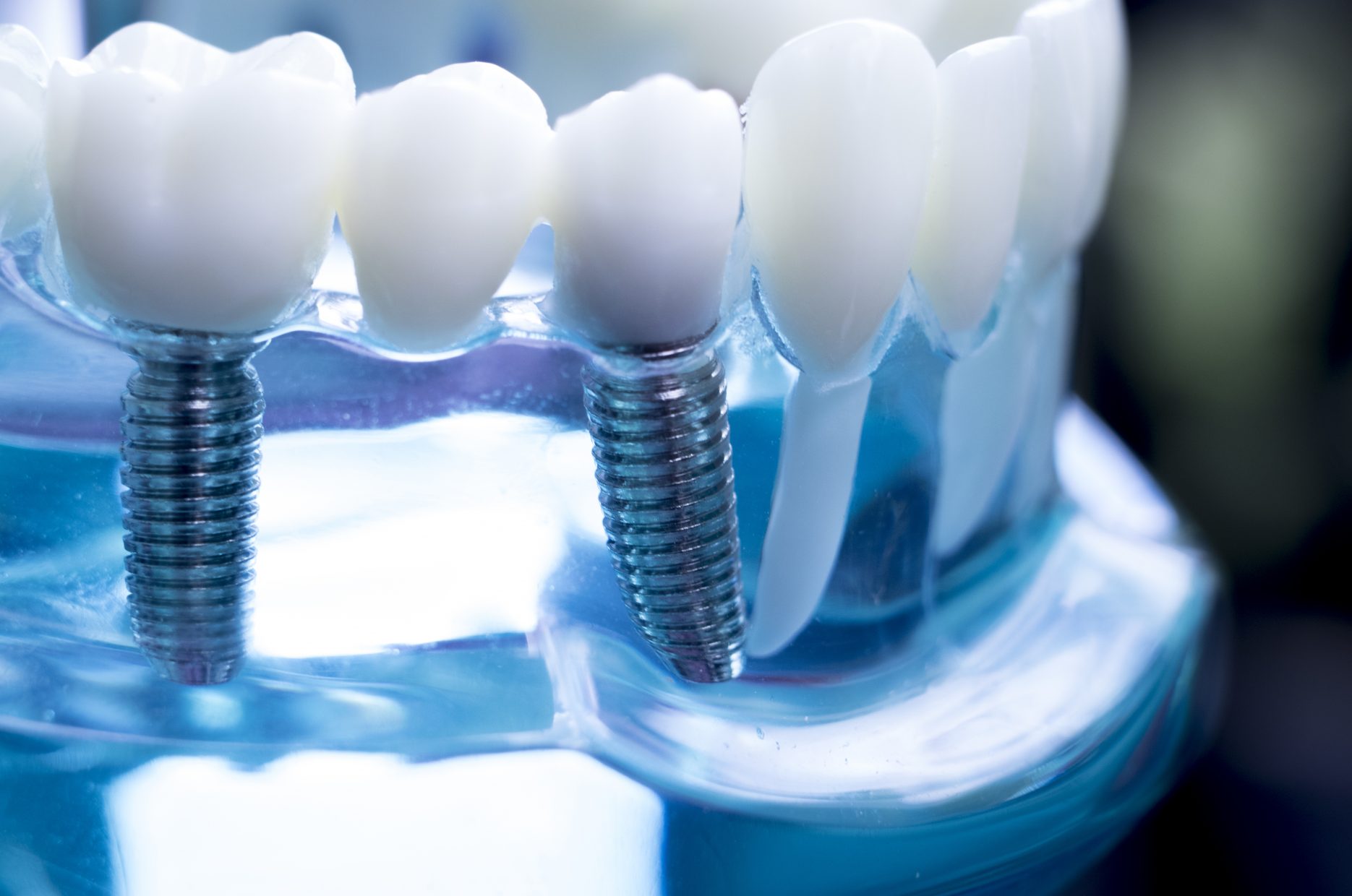 Digital Imaging Improves Dental Implants | Rowlett, TX