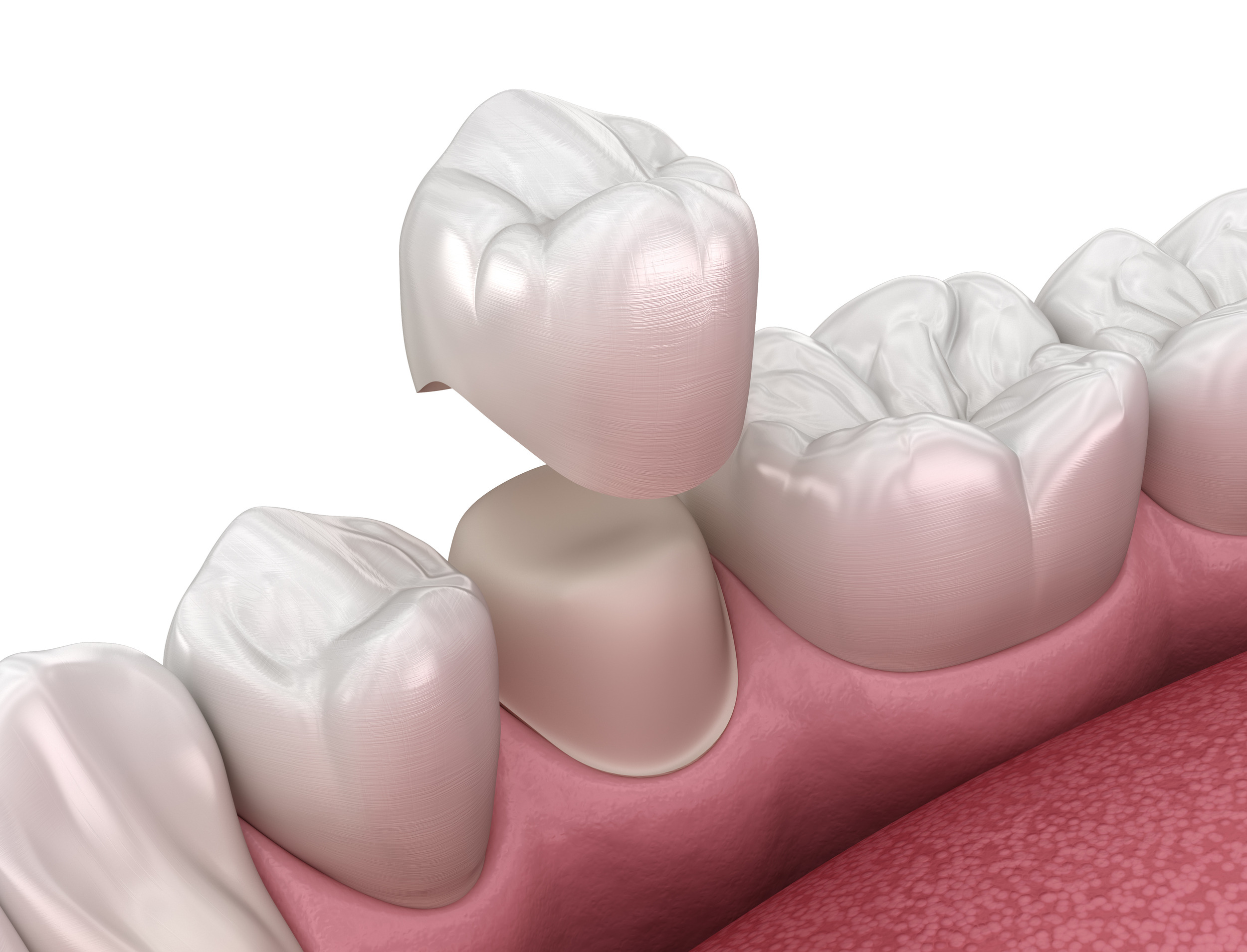Lifelike Repair With Full And Partial Crowns | Rowlett, TX