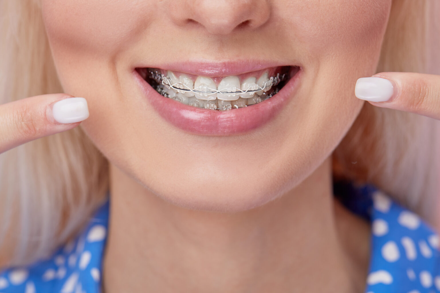 Six Month Smiles® Offers An Even Smile | Rowlett, TX