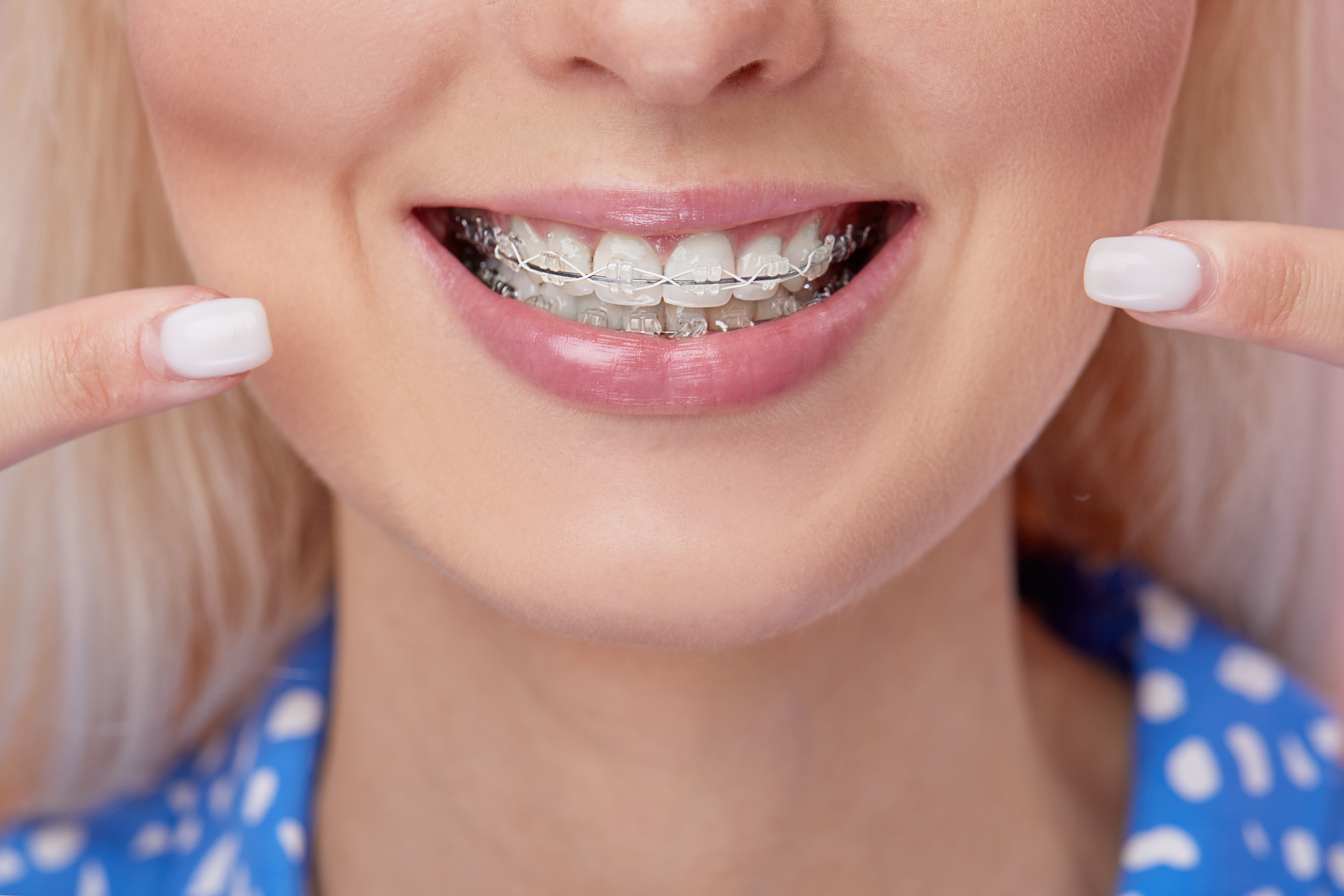 Six Month Smiles® Offers An Even Smile | Rowlett, TX